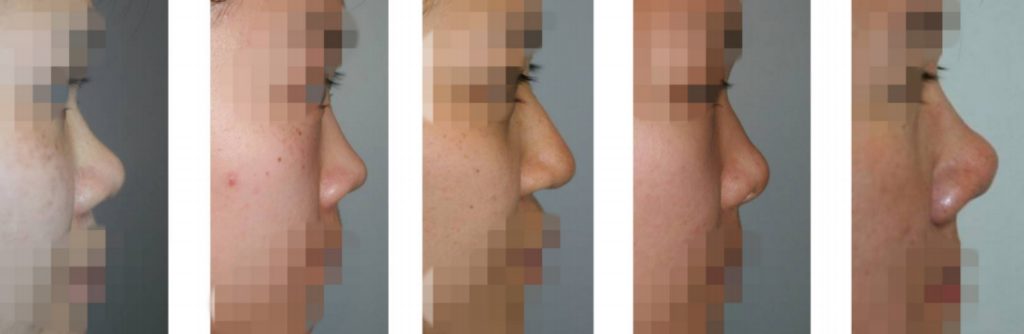 Short Nose Rhinoplasty in Korea - THE PLUS PS in Gangnam, South Korea